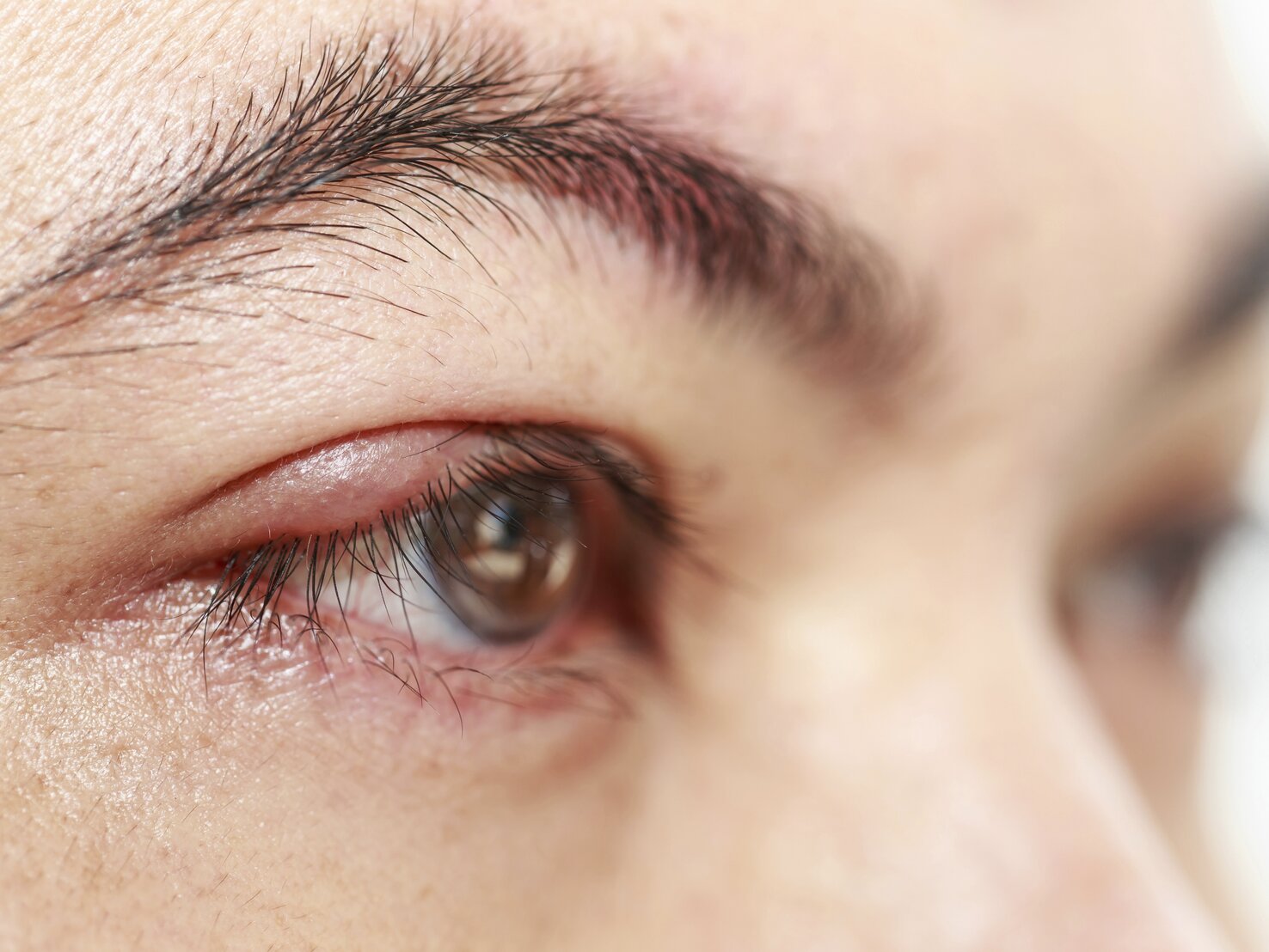 Gerstenkorn mit Hausmitteln behandeln: Diese 7 Mittel helfen